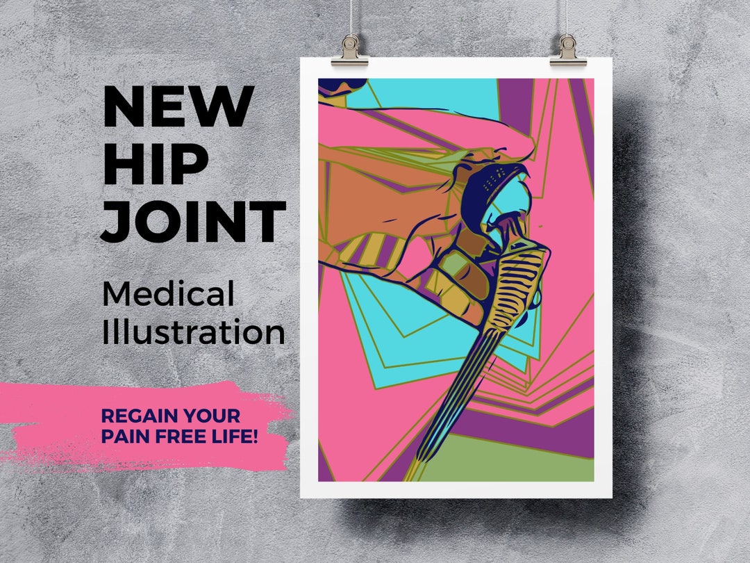 Hip Replacement Poster Medical Illustration Wall Art Downloadable ...