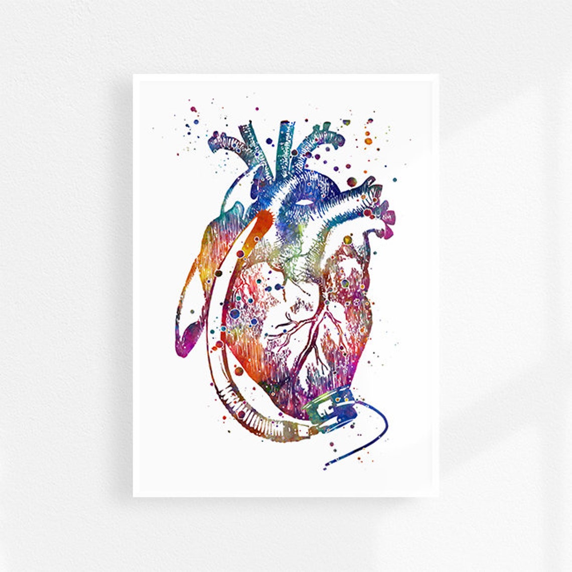 Heart With Left Ventricular Assist Device LVAD Implant - Etsy Canada