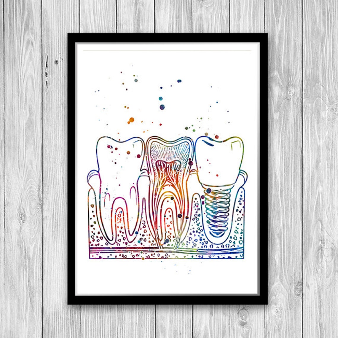 Dental implant art Dentist office decor Dental anatomy print | Etsy