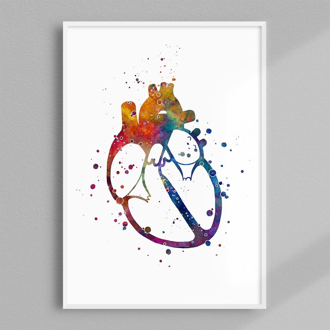 Dilated Heart, Dilated Cardiomyopathy Art Print, Heart Failure Medical ...