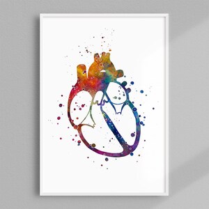 Dilated Heart, Dilated Cardiomyopathy Art Print, Heart Failure Medical ...