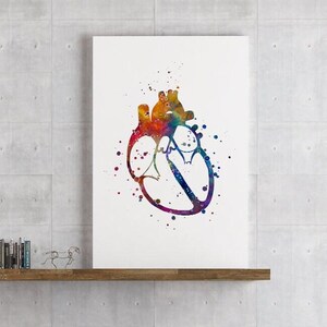 Dilated Heart, Dilated Cardiomyopathy Art Print, Heart Failure Medical ...