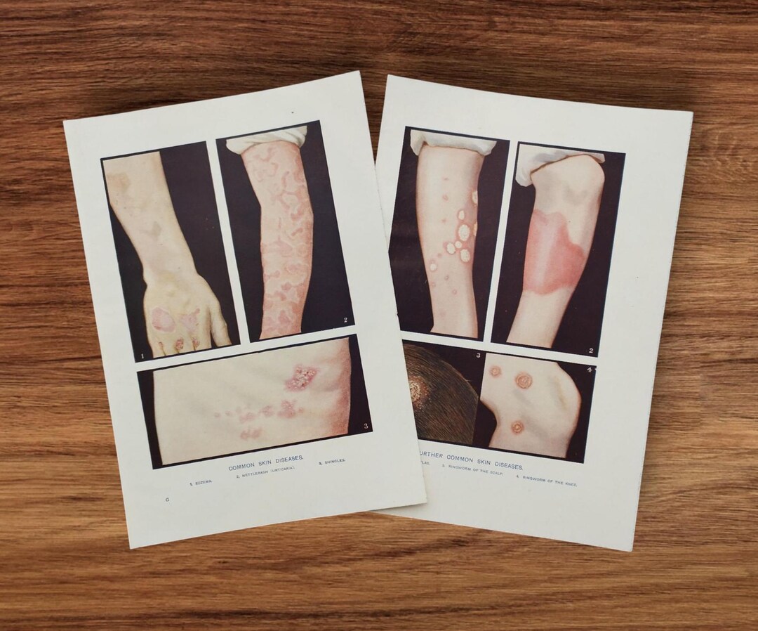 Pair of Genuine Antique 1912 Common Skin Diseases Book Print Art ...