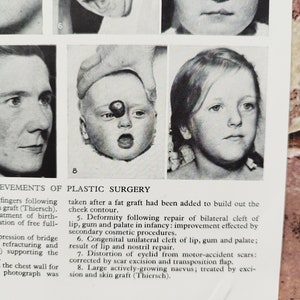 Vintage 1950s Achievements of Plastic Surgery Book Print Picture ...