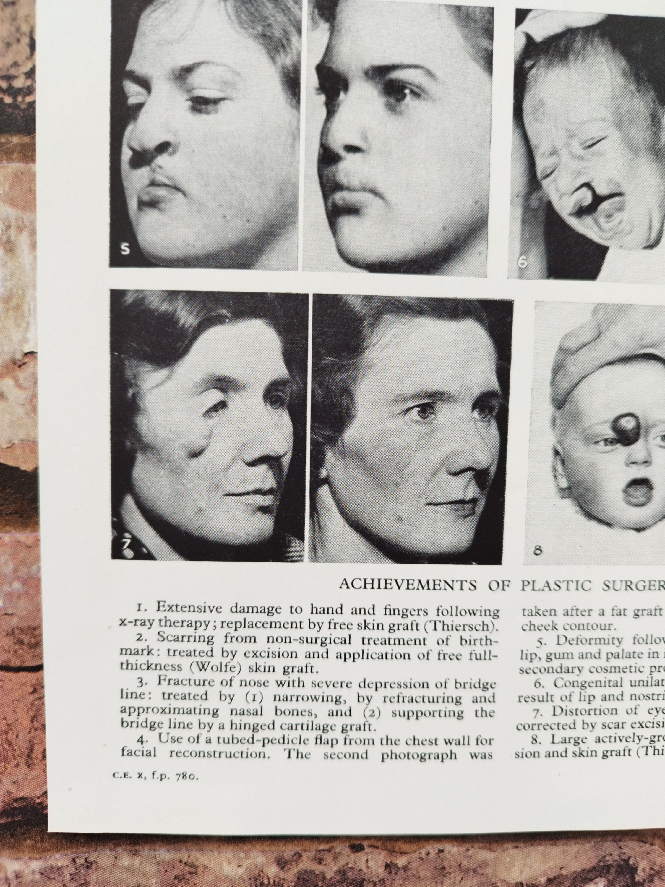 Vintage 1950s Achievements of Plastic Surgery Book Print Picture ...