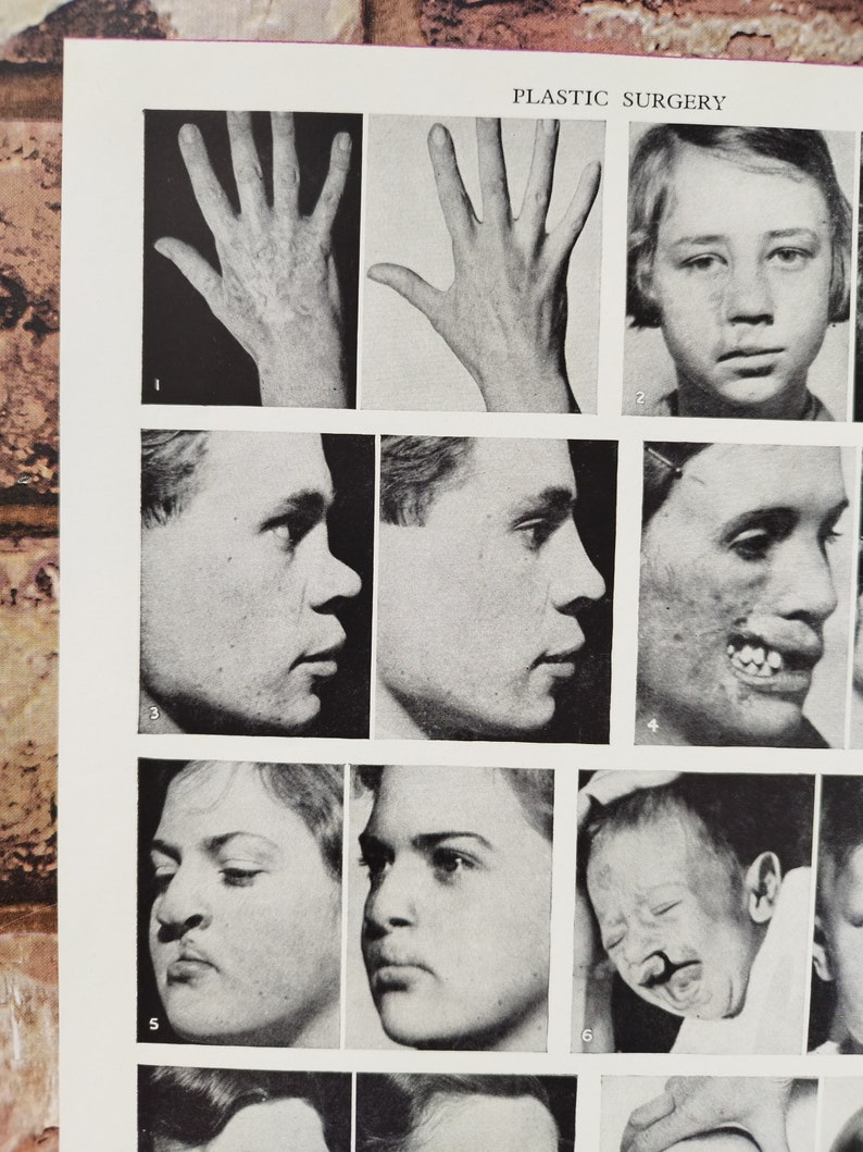 Vintage 1950s Achievements of Plastic Surgery Book Print Picture ...