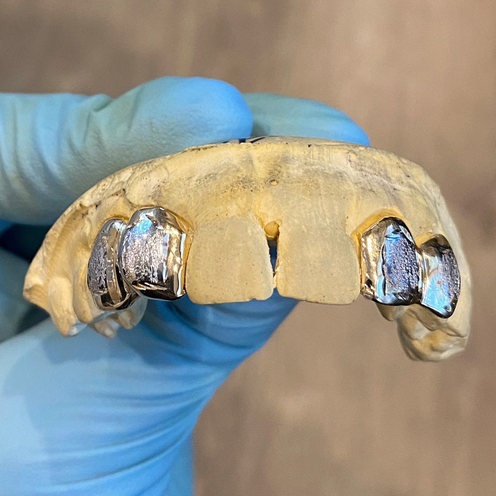 Solid 10K Gold Real Custom Cap Grillz Diamond Dust Two Tone Double ...