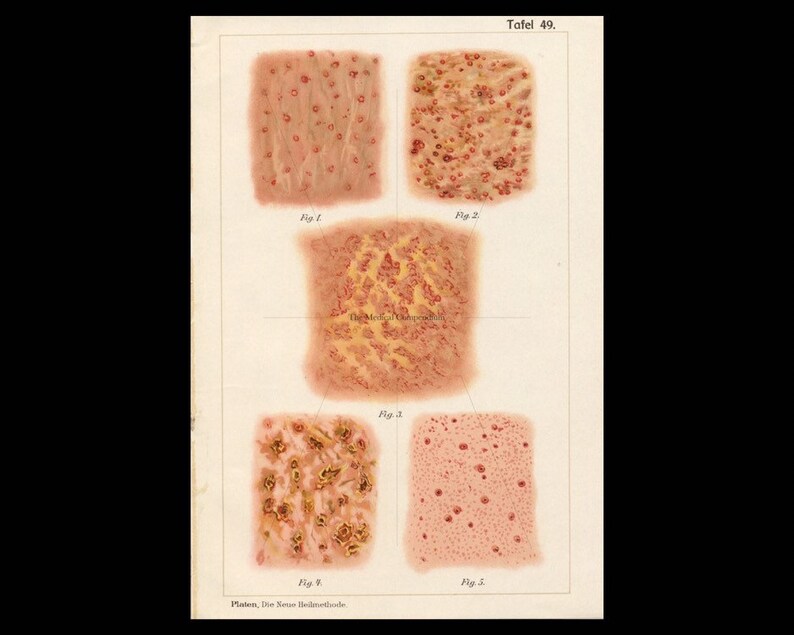 Antique Syphilis Print Venereal Disease Sexually Transmitted Infection Skin Lesions