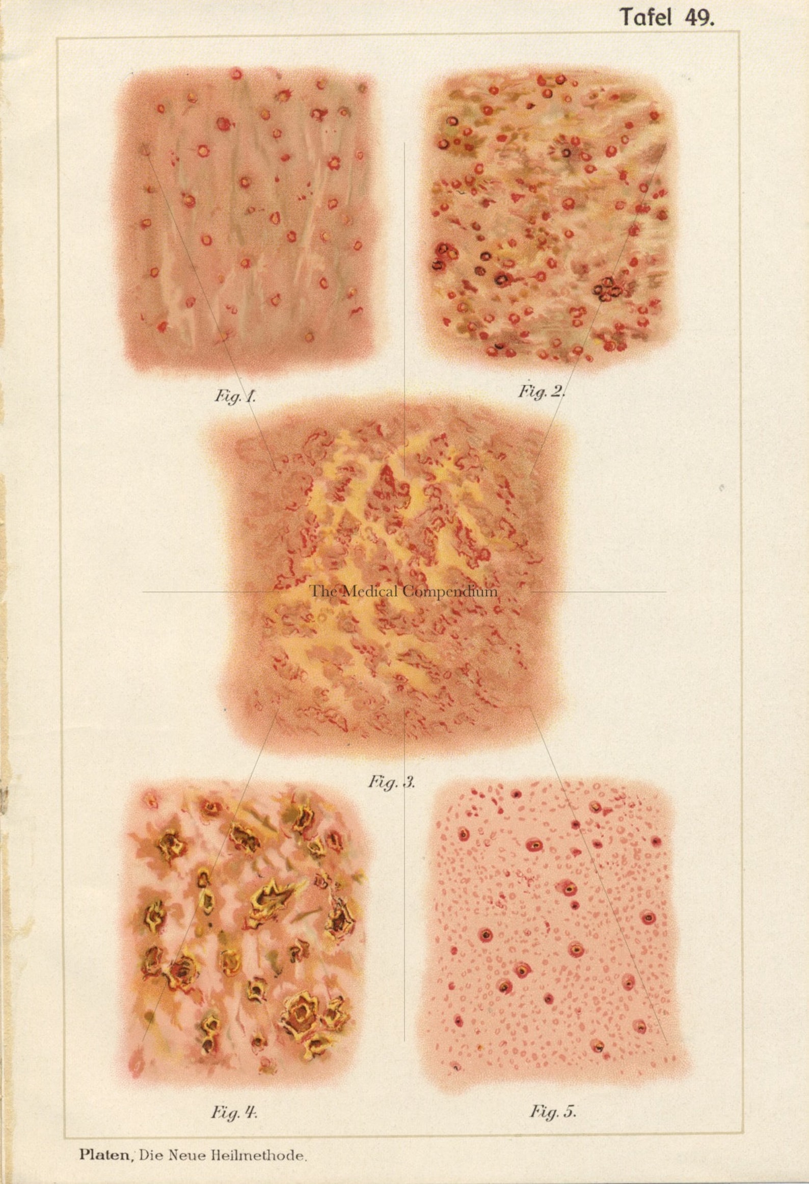 Antique Syphilis Print. Venereal Disease. Sexually Transmitted ...