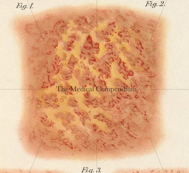 Antique Syphilis Print. Venereal Disease. Sexually Transmitted ...