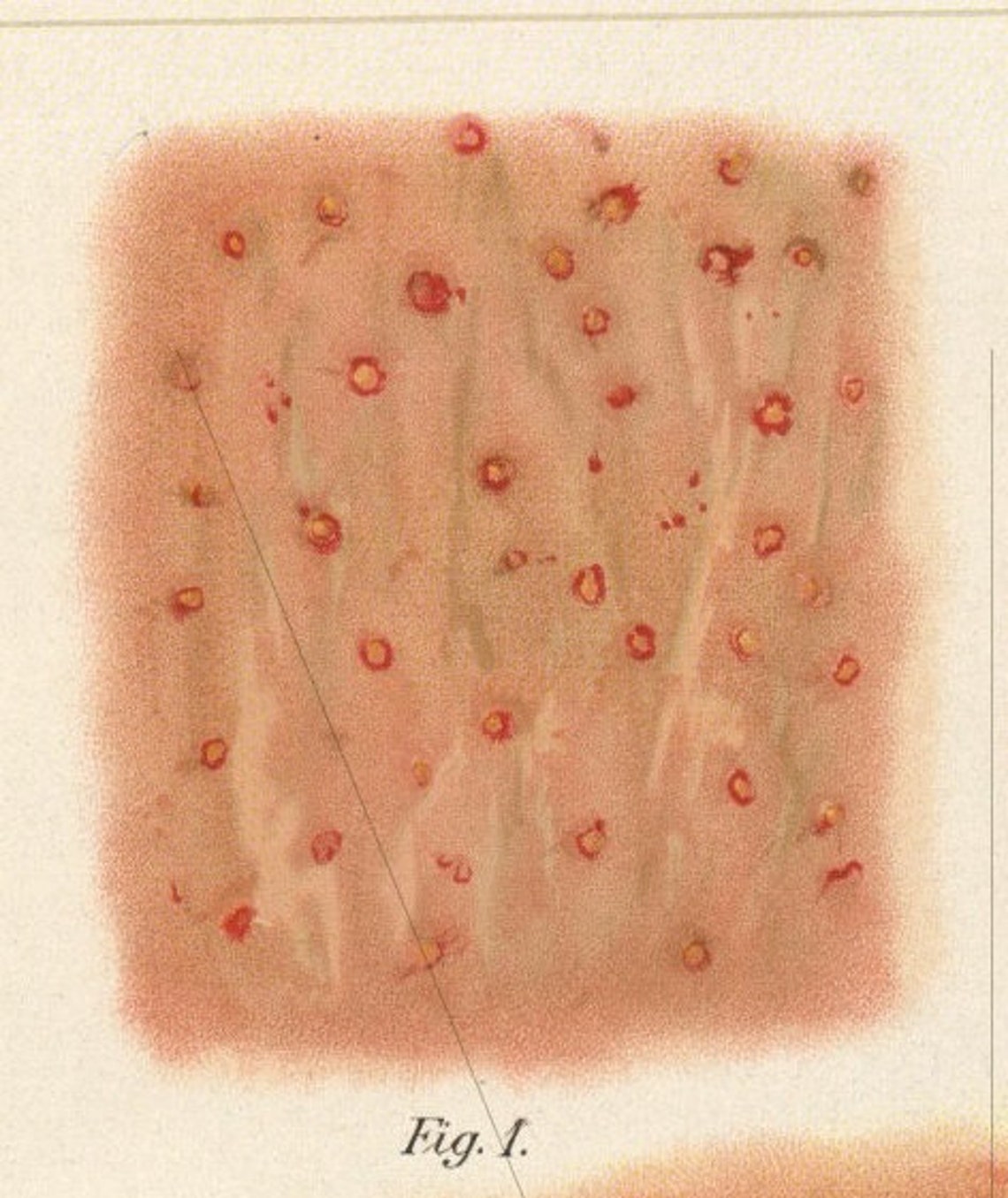 Antique Syphilis Print Venereal Disease Sexually Transmitted Infection Skin Lesions