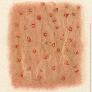 Antique Syphilis Print. Venereal Disease. Sexually Transmitted ...