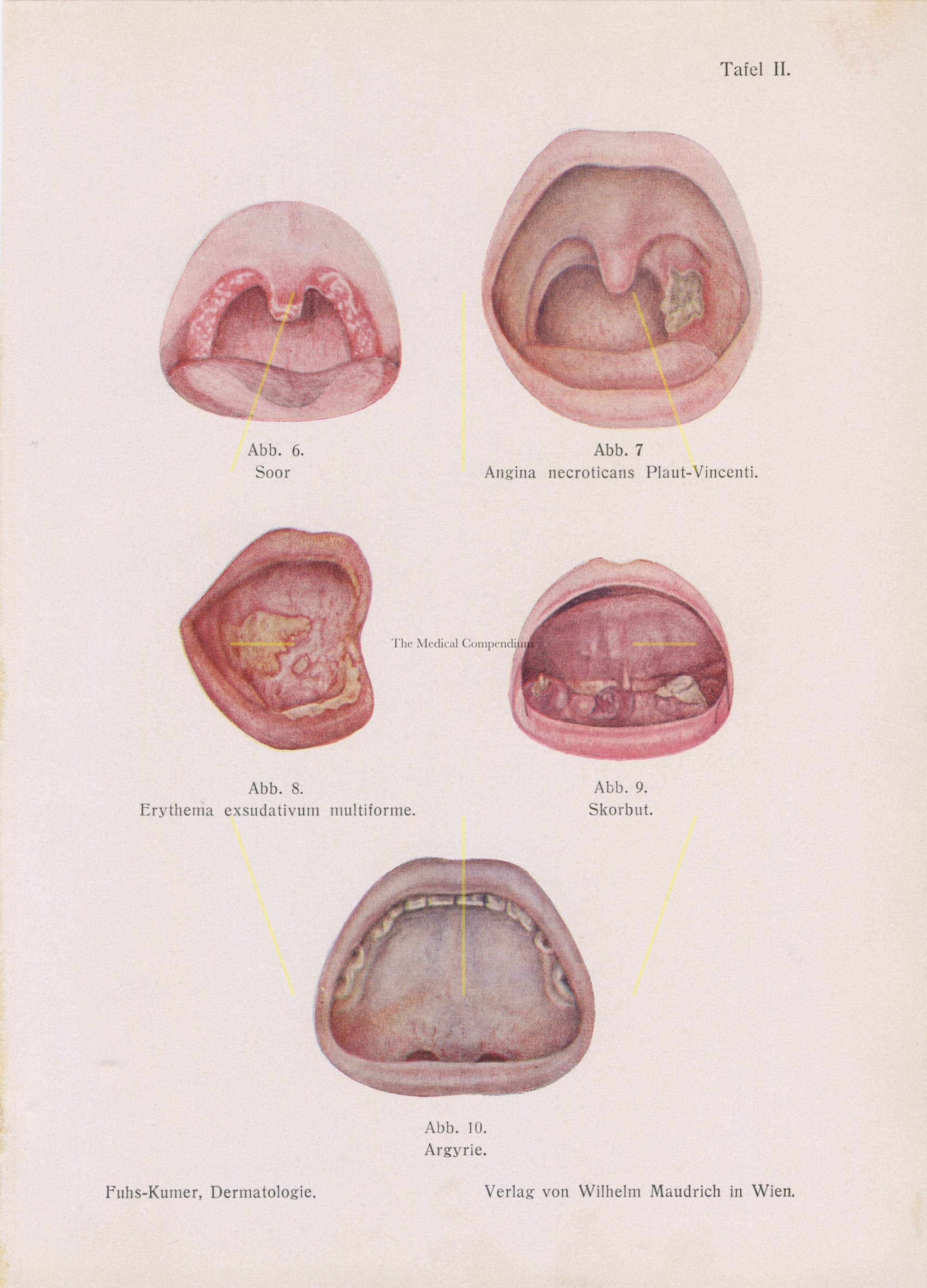 Vintage Mouth Disease Print Candidiasis Scurvy Vincents Angina Argyria ...