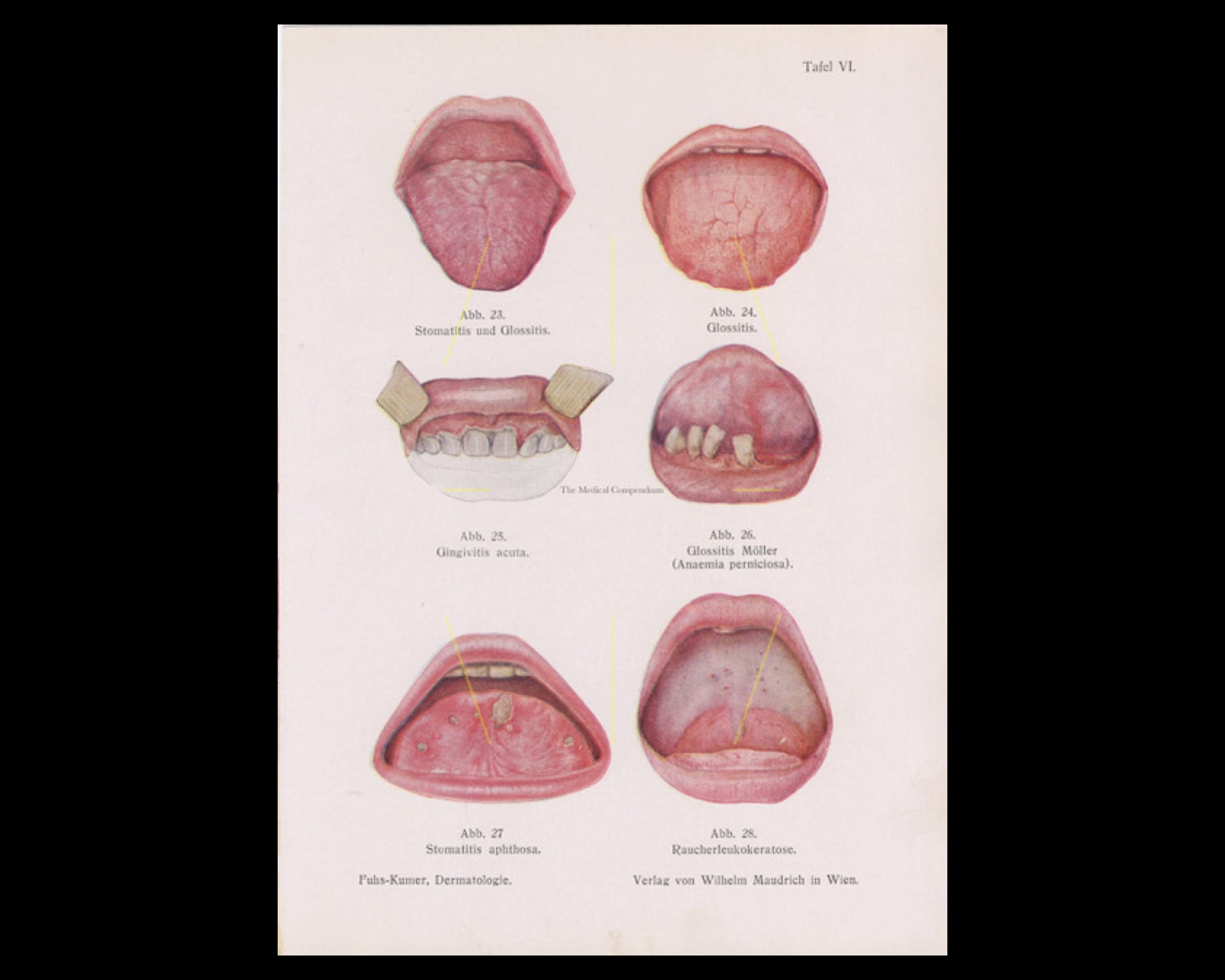 Stomatitis