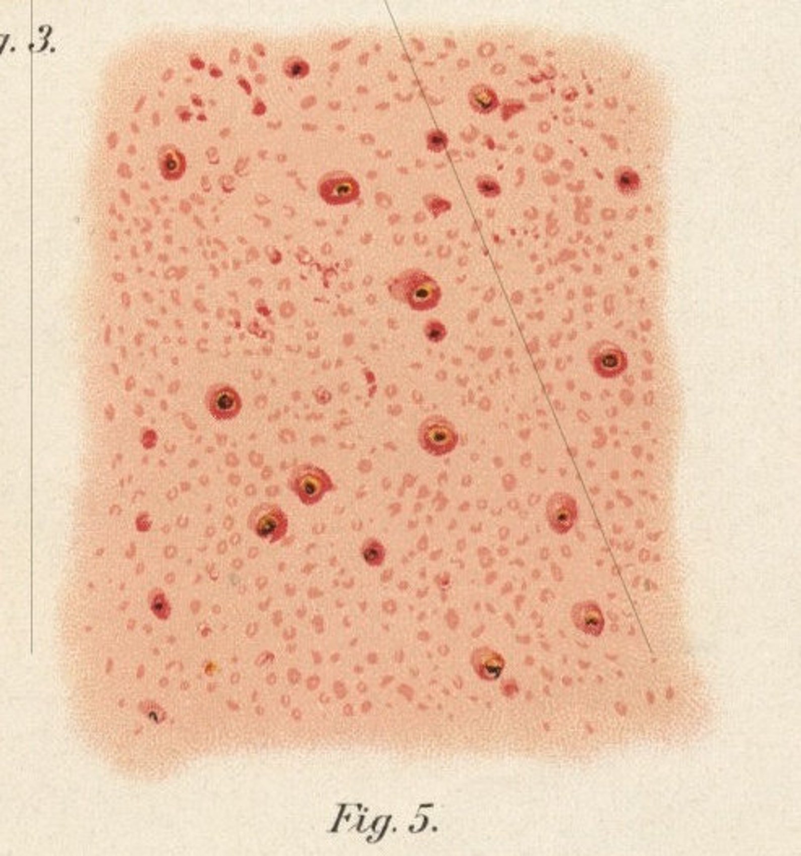 Antique Syphilis Print Venereal Disease Sexually Transmitted Infection Skin Lesions