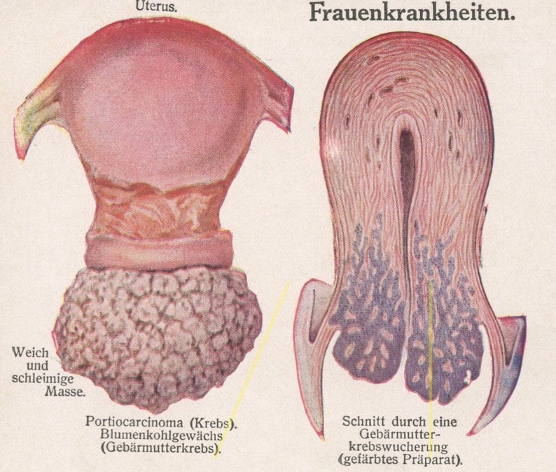 Vintage Venereal Disease Print Female Reproductive System Womens