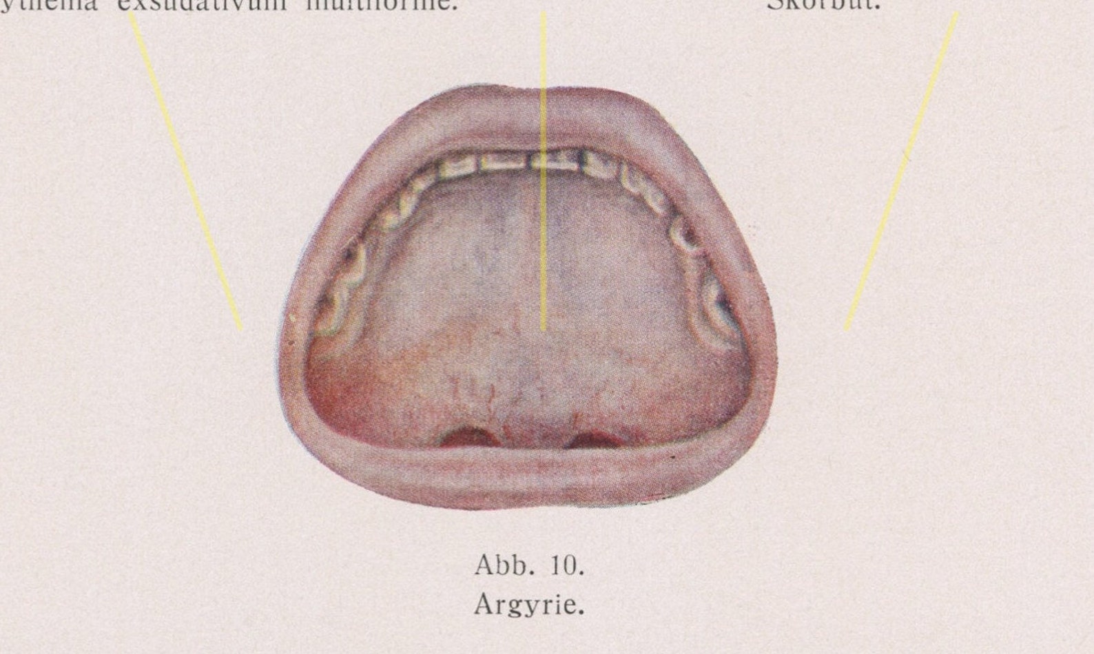 Vintage Mouth Disease Print Candidiasis Scurvy Vincents Angina Argyria ...