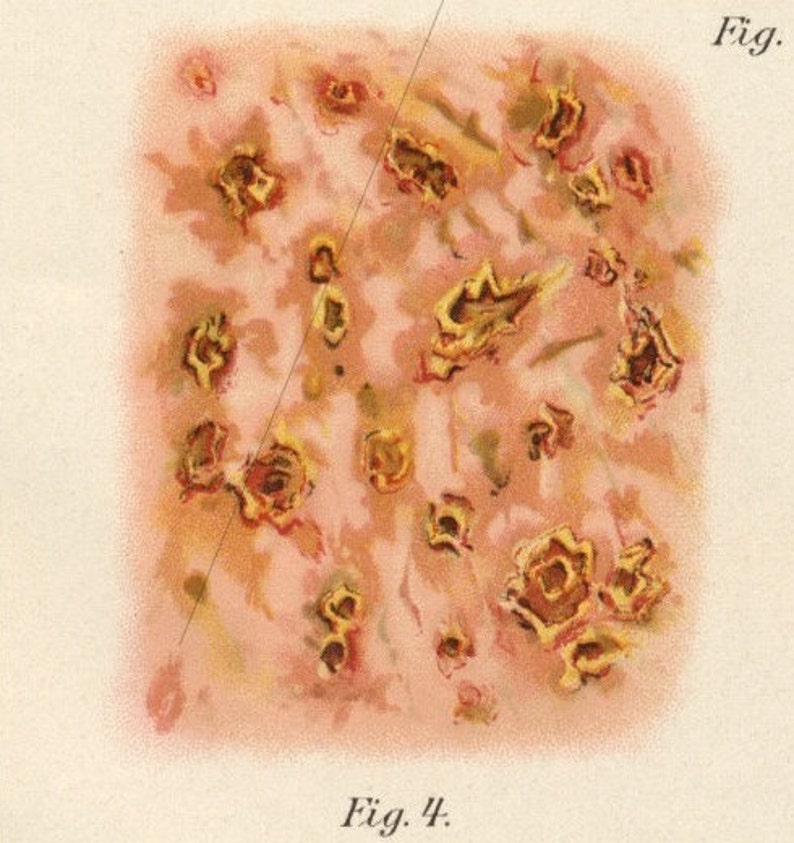 Antique Syphilis Print Venereal Disease Sexually Transmitted Infection Skin Lesions
