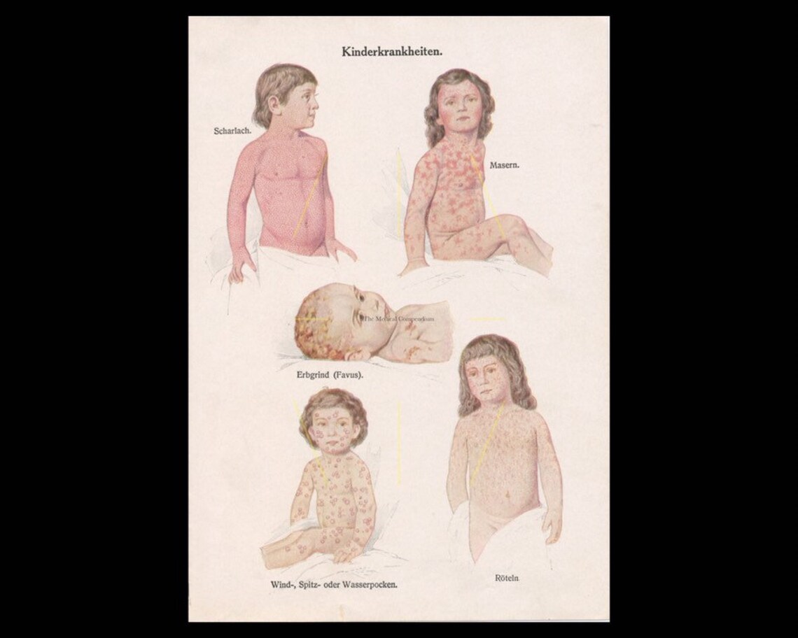 Vintage Infectious Diseases Print. Medical Oddities. Scarlet Fever ...