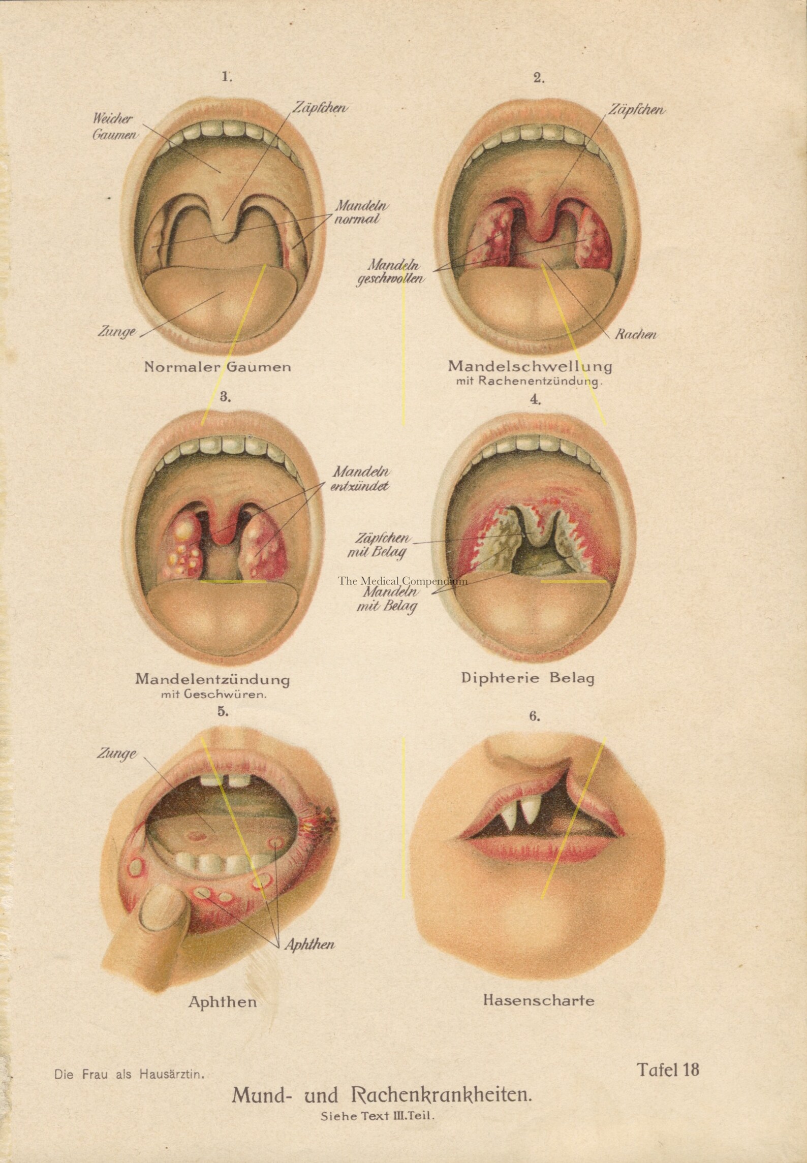Antique Mouth Disease Print. Diphtheria. Medical Art. Tonsils. Cleft ...