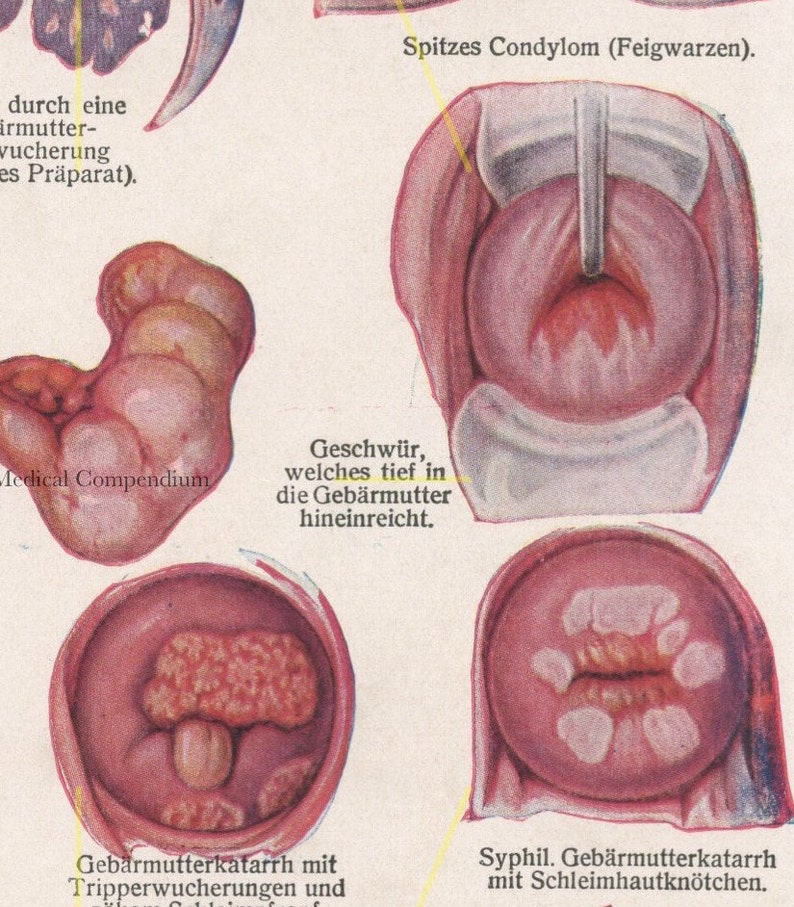 Vintage Venereal Disease Print Female Reproductive System Women s vintage-venereal-disease-print-female-reproductive-system-women-s