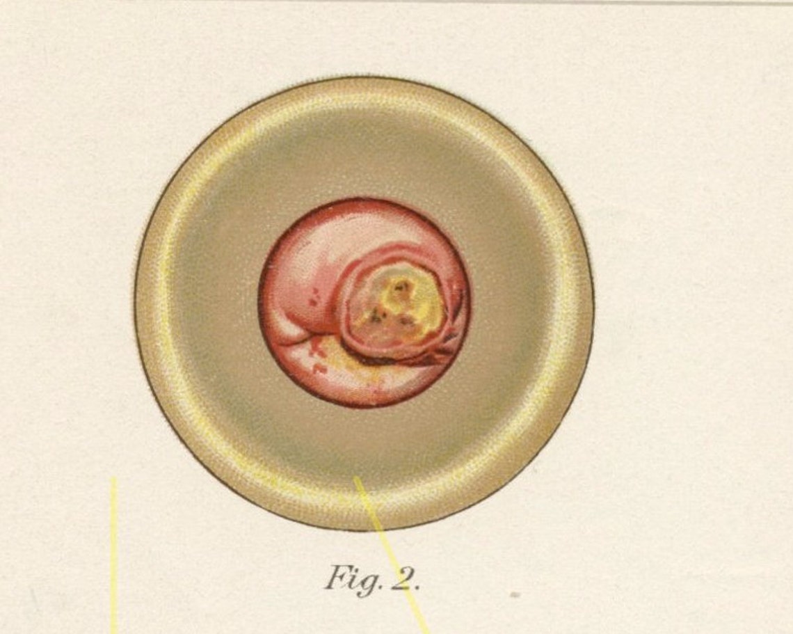 Antique syphilis print. Medical illustration. STD. Chancre. | Etsy
