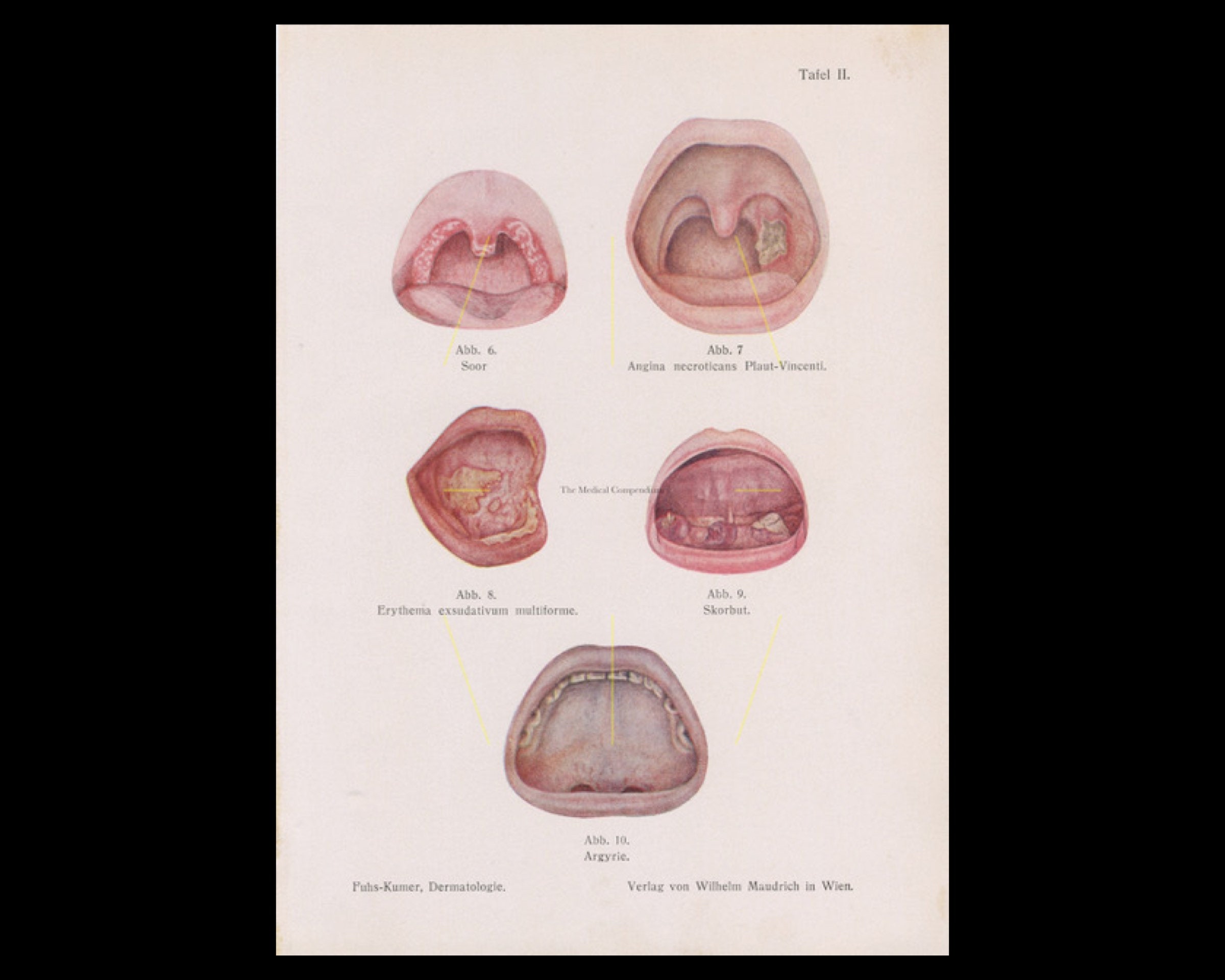 Vincents Angina