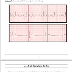 2024 Updated EKG/ECG Heart Arrhythmias Study Guide 55 Pages, 35 ...