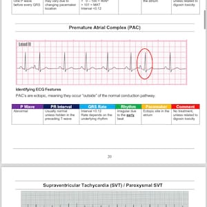 2024 Updated EKG/ECG Heart Arrhythmias Study Guide 55 Pages, 35 ...