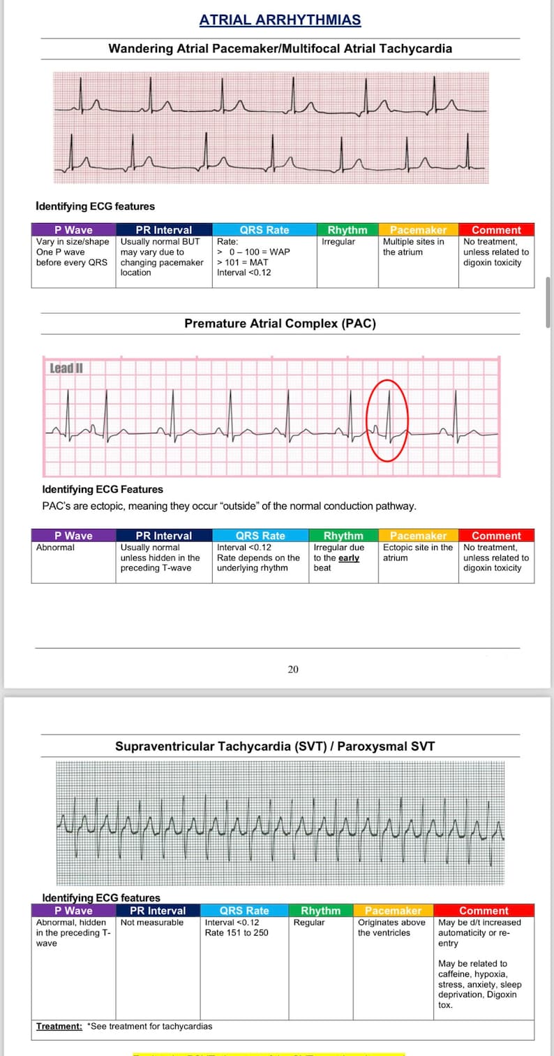 2024 Updated EKG/ECG Heart Arrhythmias Study Guide 55 Pages, 35 ...