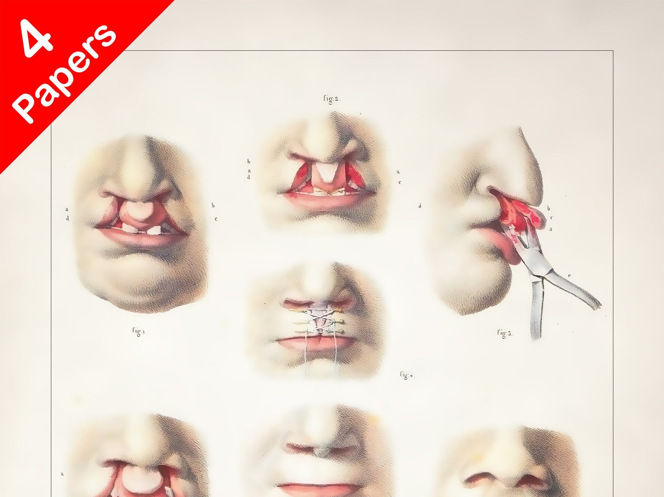 CLEFT LIP PALATE Anatomy Art Print for Medical Student - Etsy