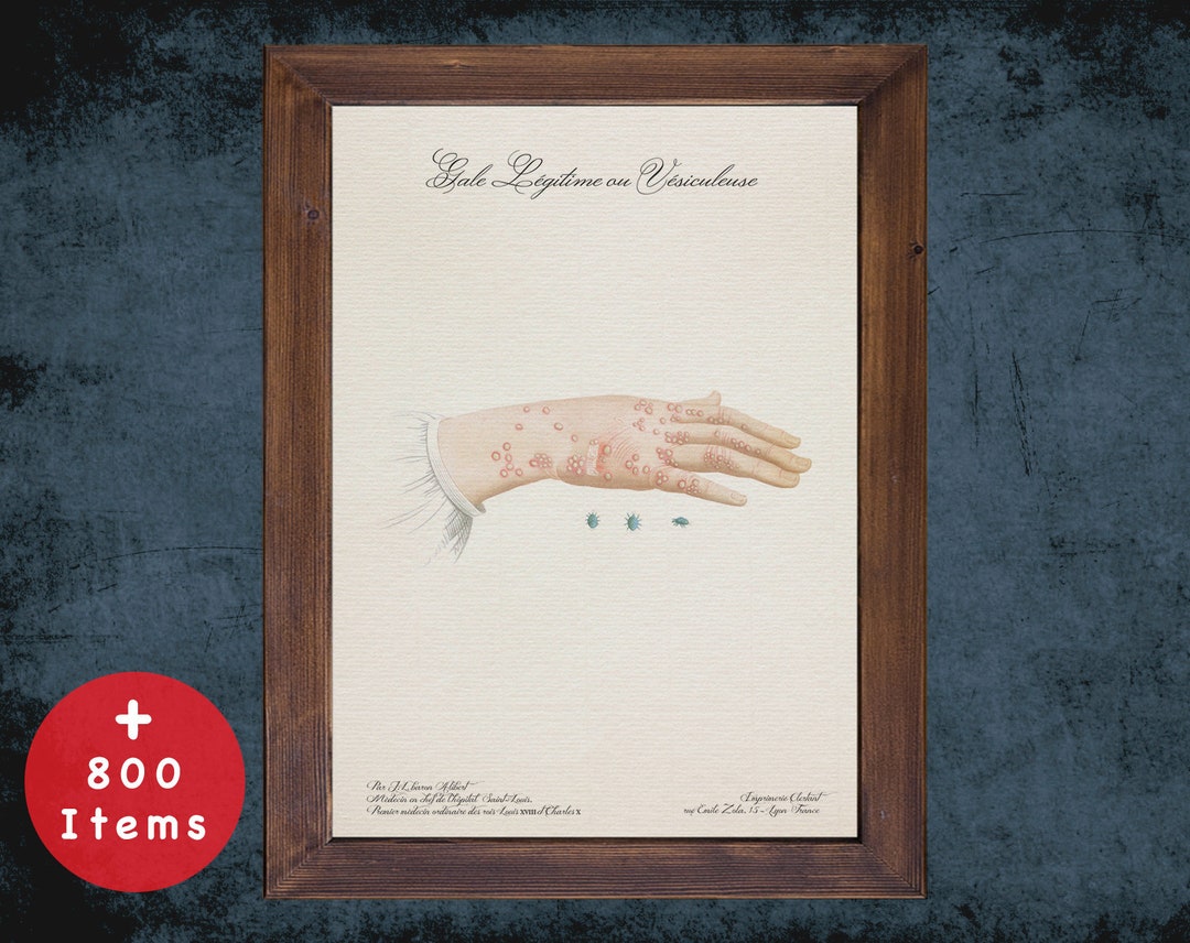 SCABIES ITCH Anatomy Art Print for Medical Student Gift, Dermatologist ...