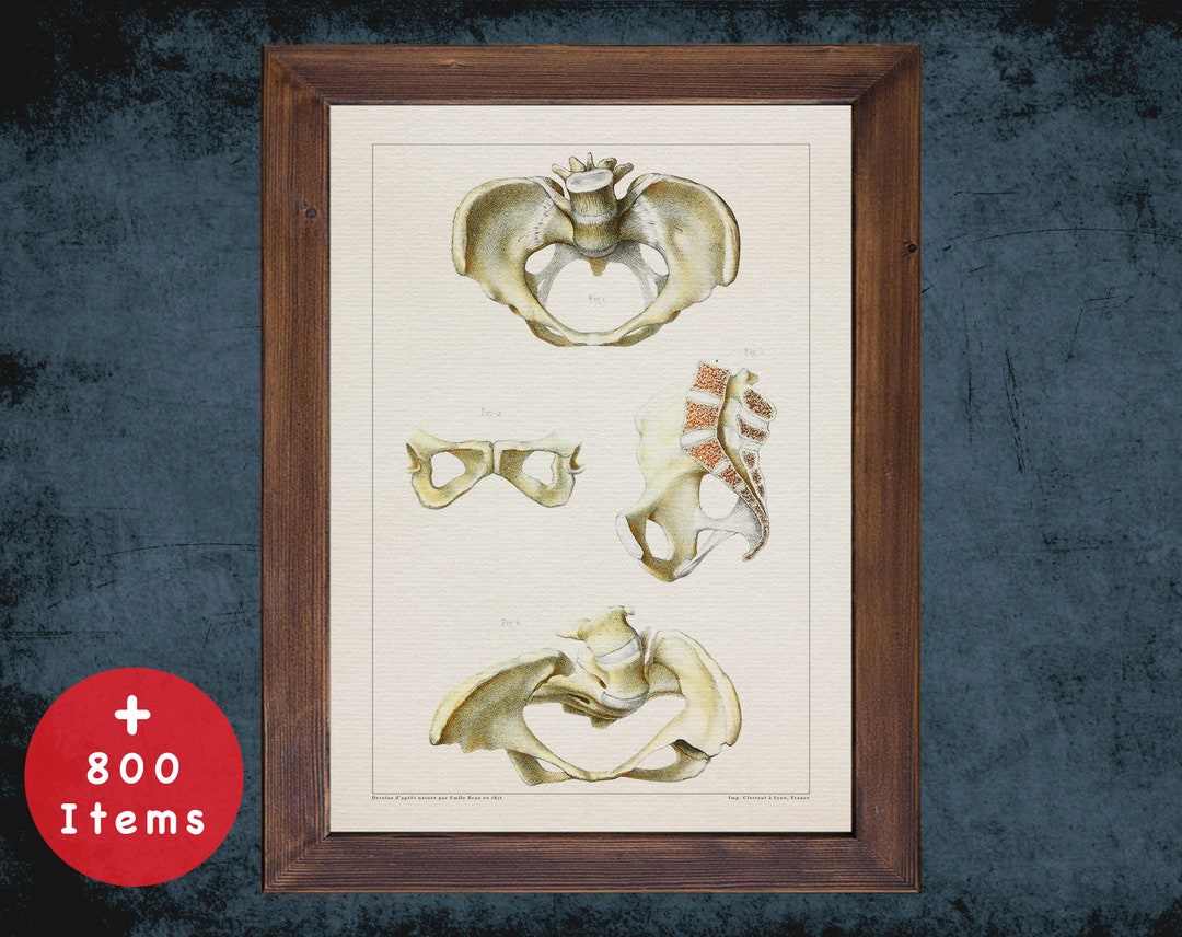 RICKETS PELVIC BONES Anatomy Art Print for Medical Student Graduate ...