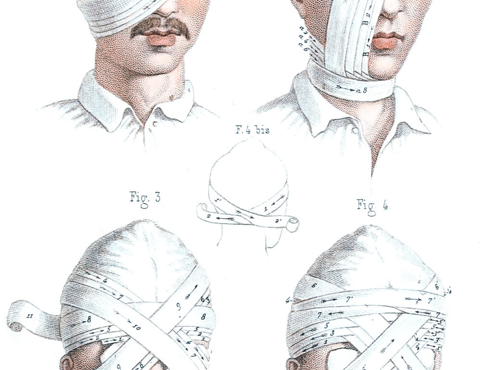 EYES BANDAGE INSTRUCTION anatomy art print for medical student | Etsy