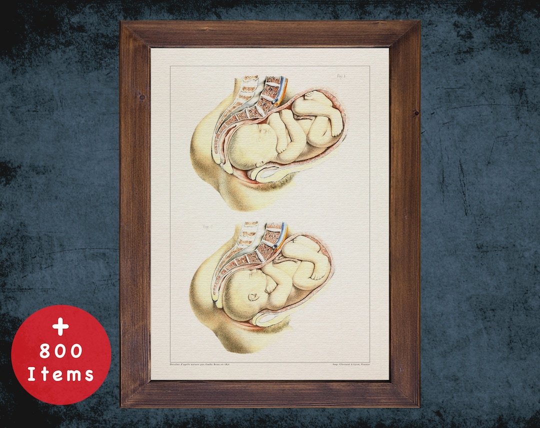 BABY BIRTH MIDWIFERY Anatomy Art Print for Medical Student Graduate ...