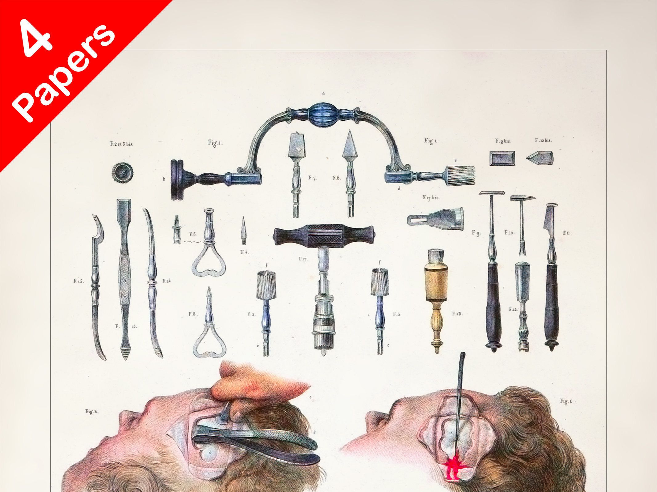 SKULL TREPANNING SURGERY Anatomy Art Print for Medical Student - Etsy