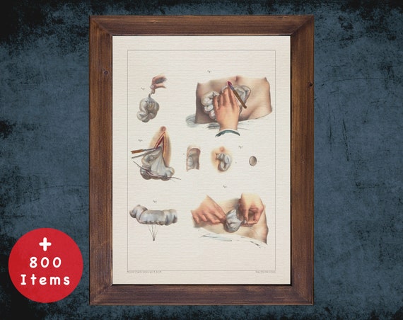 INTESTINE BOWEL OBSTRUCTION Anatomy Art Print for Medical - Etsy Finland