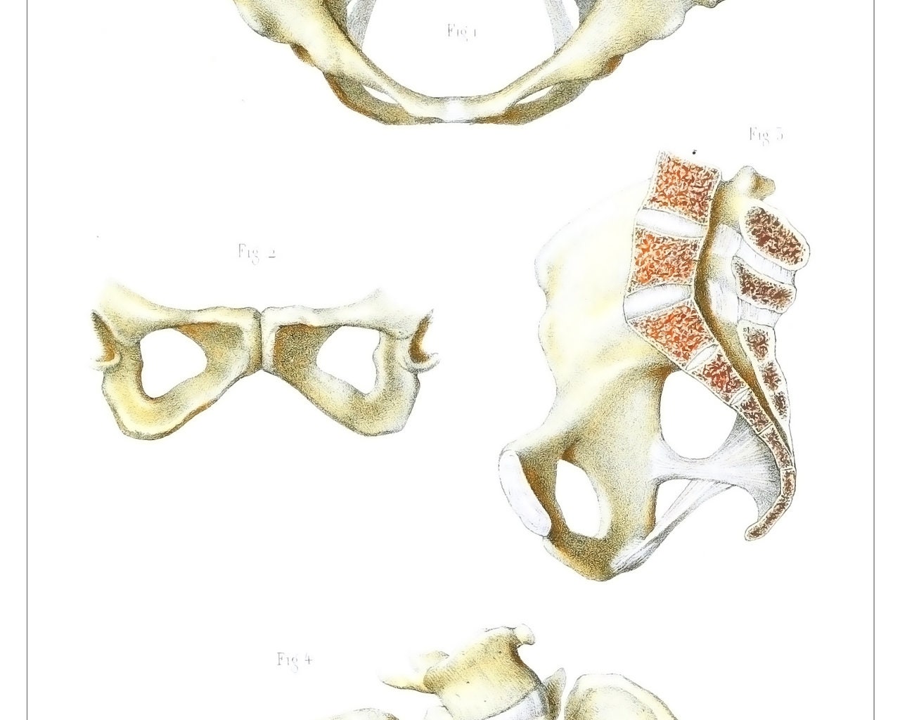 RICKETS PELVIC BONES Anatomy Art Print for Medical Student Graduate ...