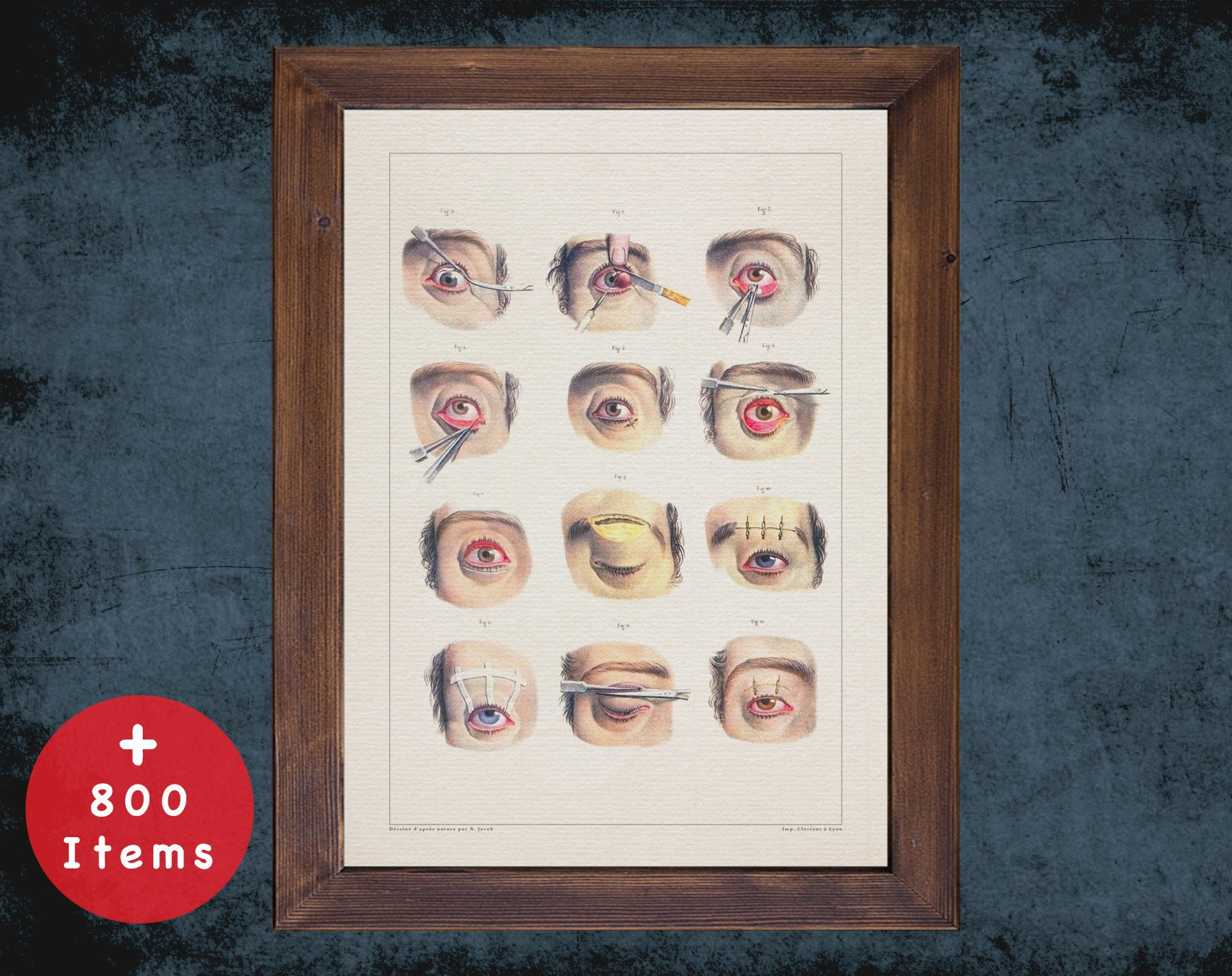 EYE BLEPHAROPLASTY EYELID Anatomy Art Print for Medical Student ...