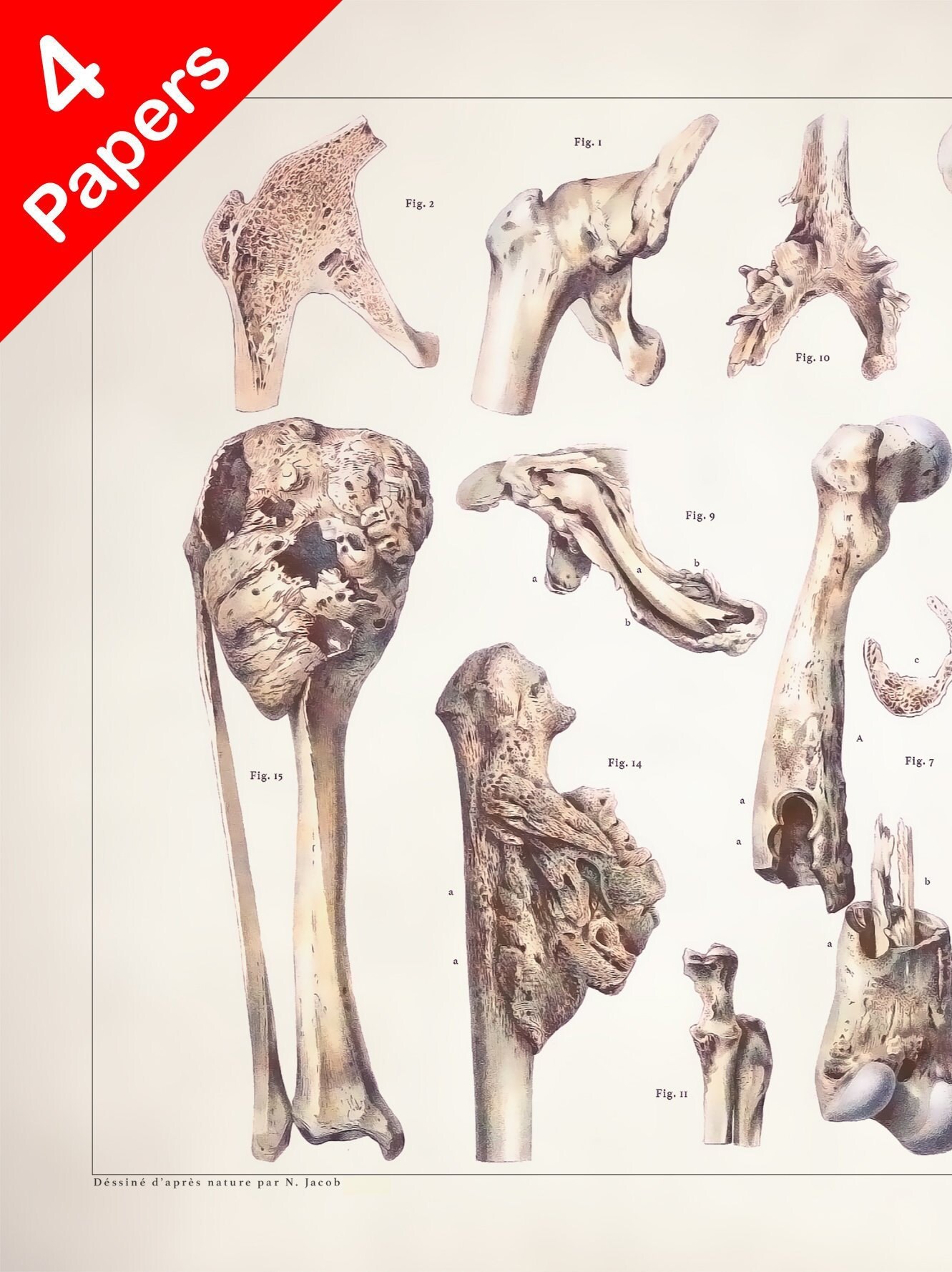 BONES DISEASE SARCOMA Anatomy Art Print for Medical Student | Etsy