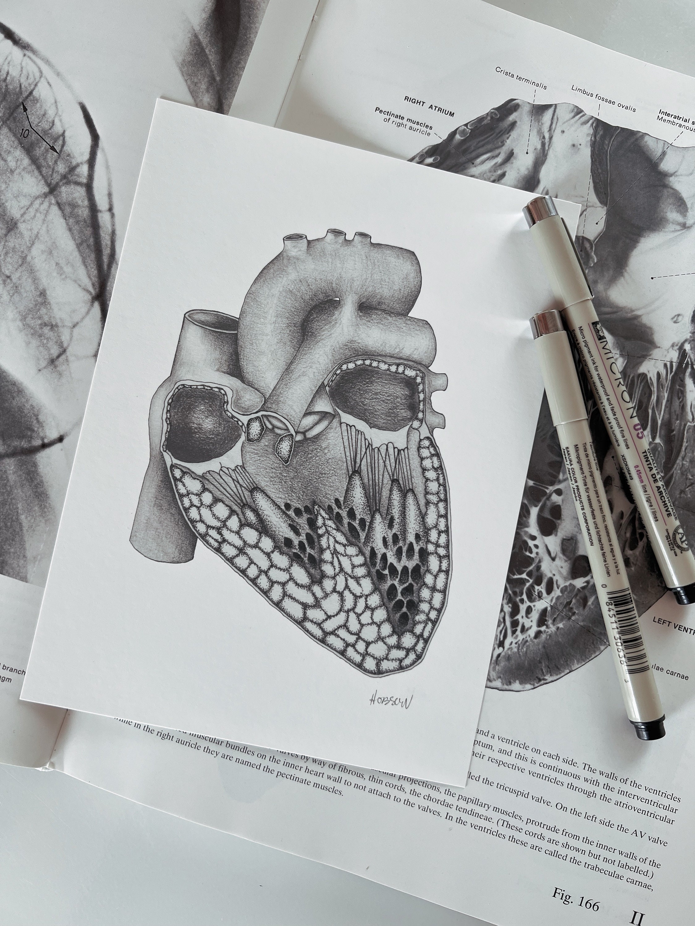 Tetralogy of Fallot Print - Anatomical Heart Drawing - Cardiology Gift ...