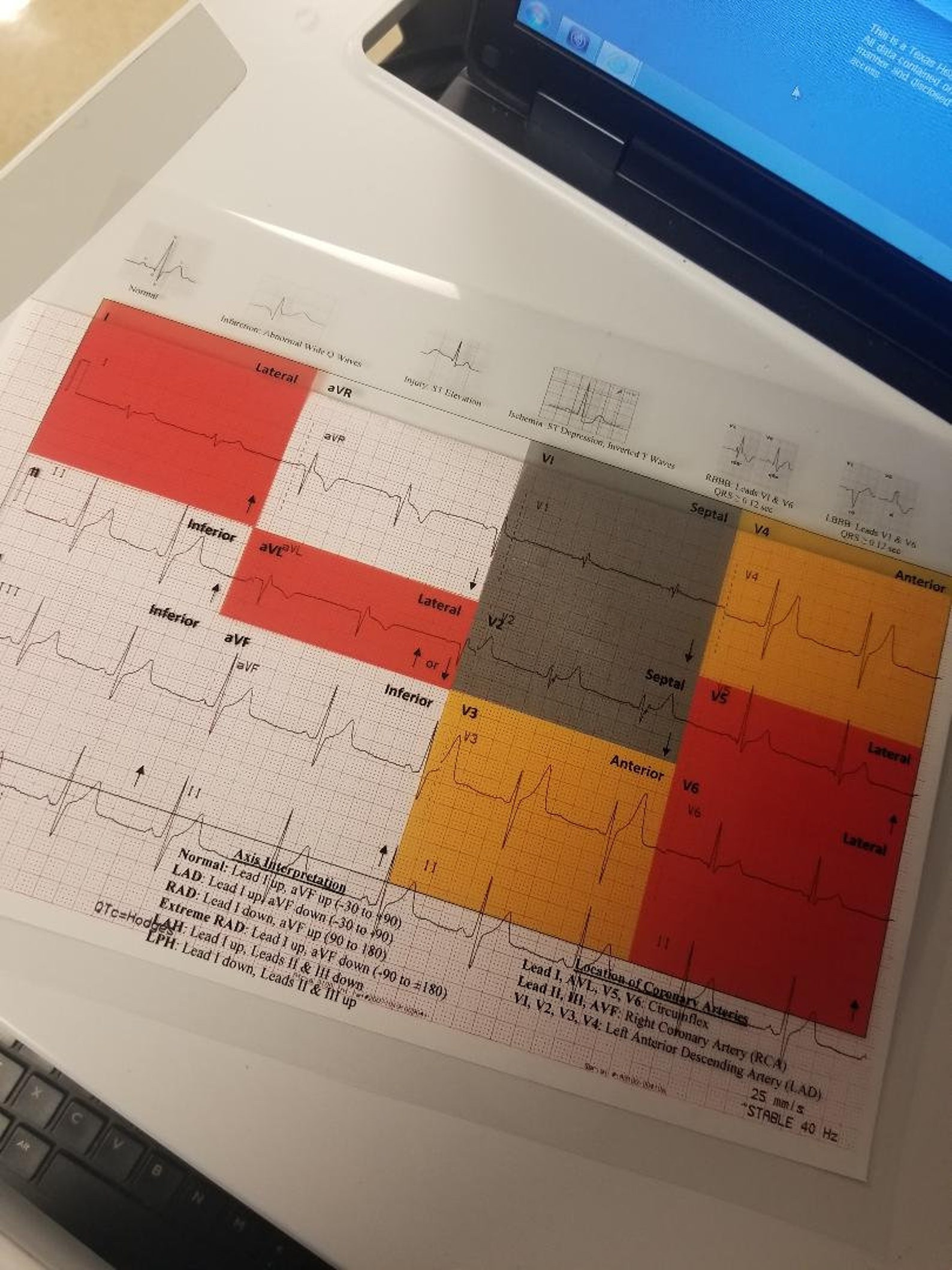 Transparent 12-lead EKG Reader Sheet - Etsy