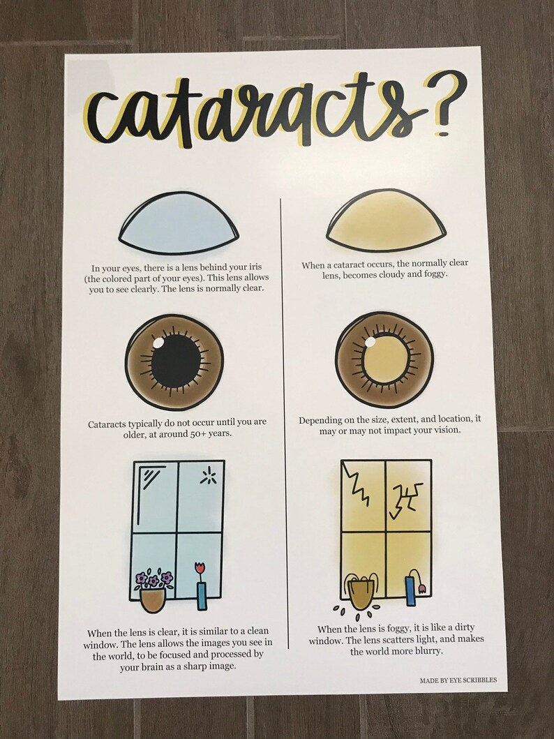 Cataract Educational Poster: Optometry Office Wall Decor - Etsy