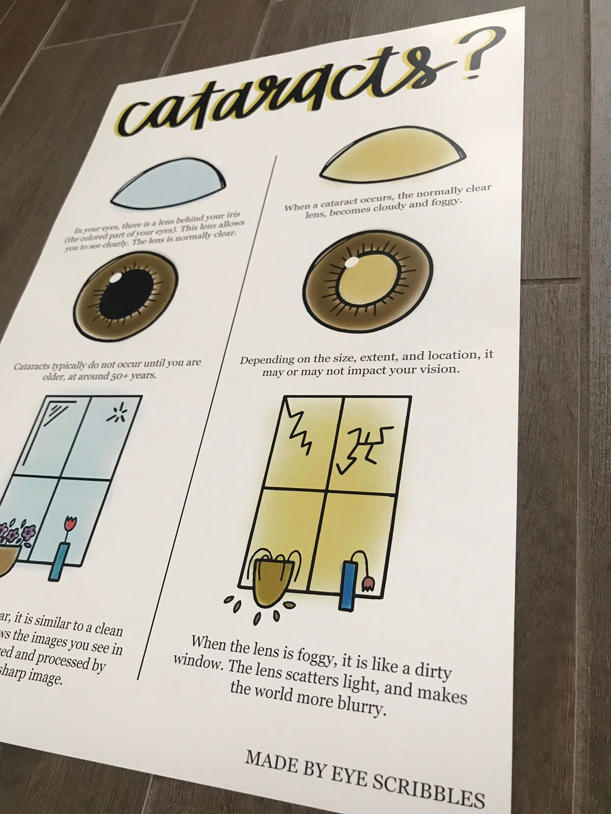 Cataract Educational Poster: Optometry Office Wall Decor - Etsy