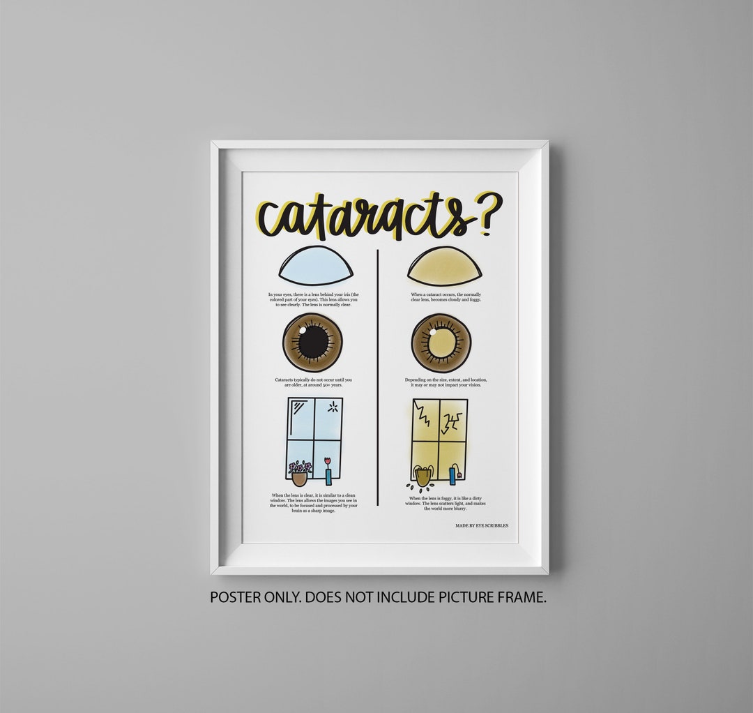 Cataract Educational Poster: Optometry Office Wall Decor - Etsy