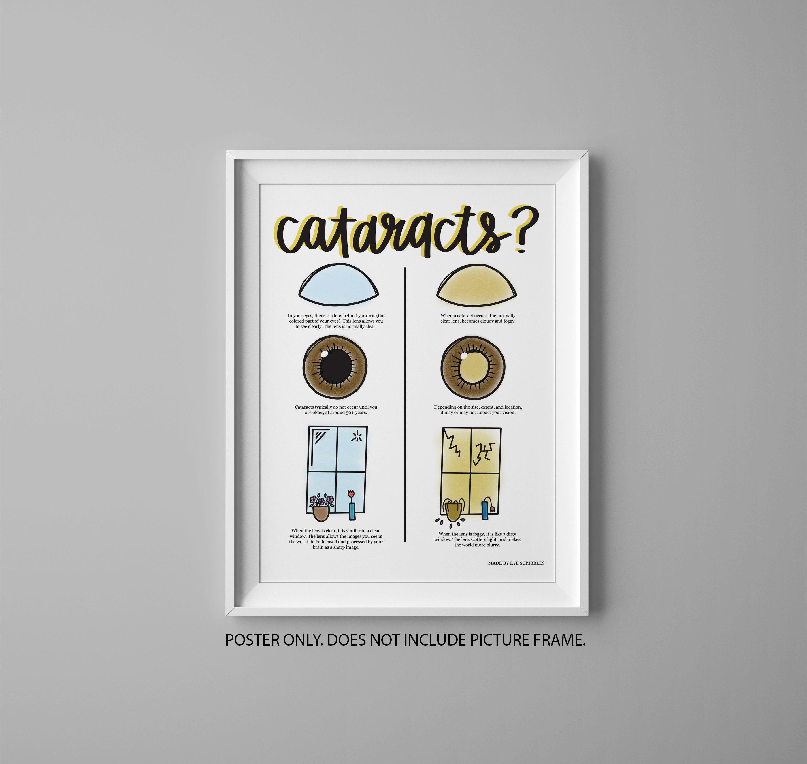 Cataract Poster Cataract Educational Poster Optometry Wall - Etsy Canada