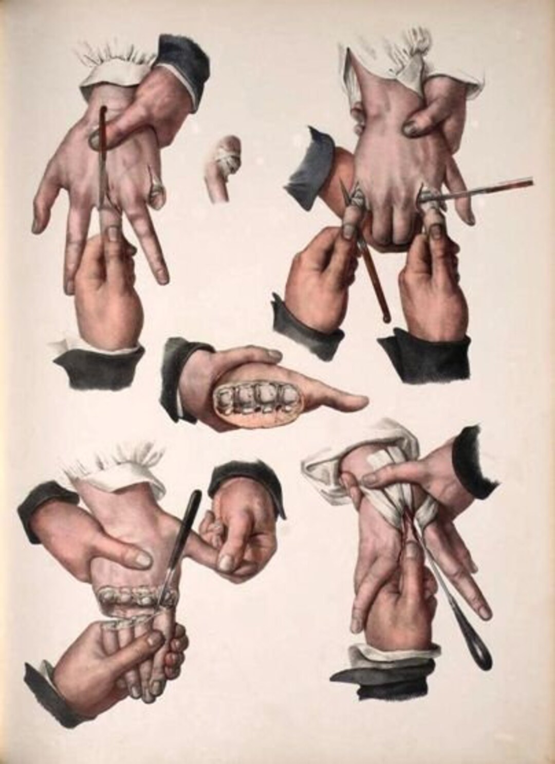 Antique 19th C. Medical Print Examples of Finger Amputation A3 Poster ...