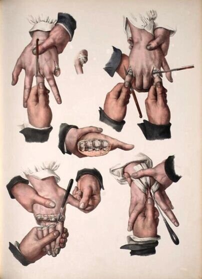 Antique 19th C. Medical Print Examples of Finger Amputation A3 Poster ...