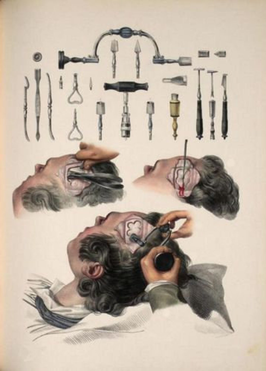 Antique Medical Surgical Trephining Tools A3 Re Print - Etsy