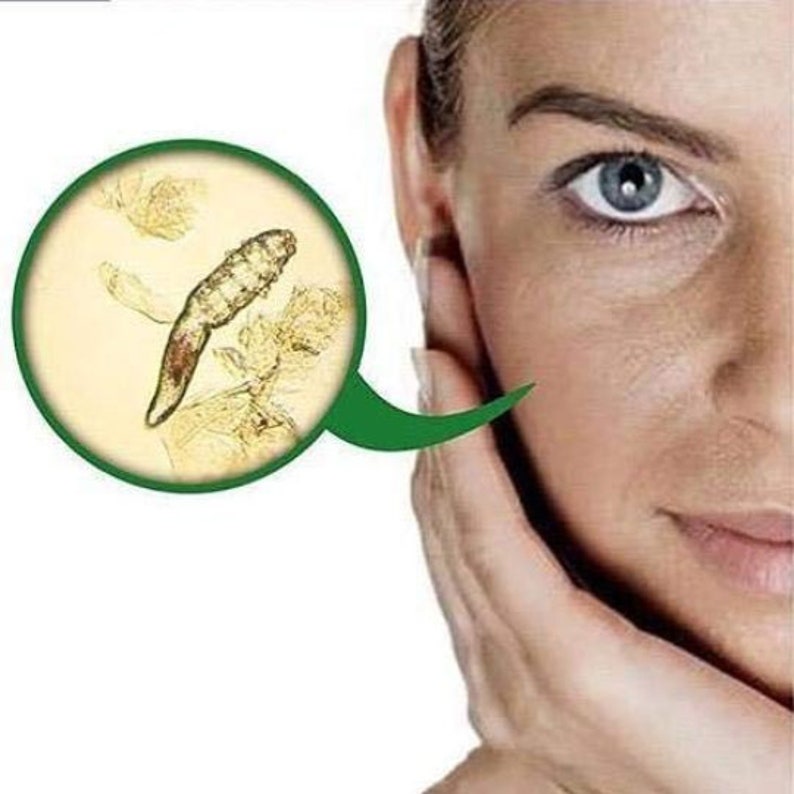 Treat Skin Mite Lesion, Formication, Crawling Sensation Rash Itching ...